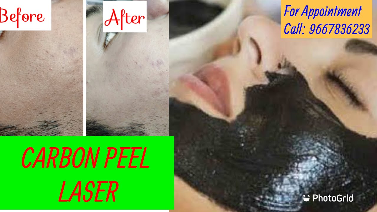 Carbon Peel Laser/Facial, Carbon peel for glowing skin, How is carbon ...