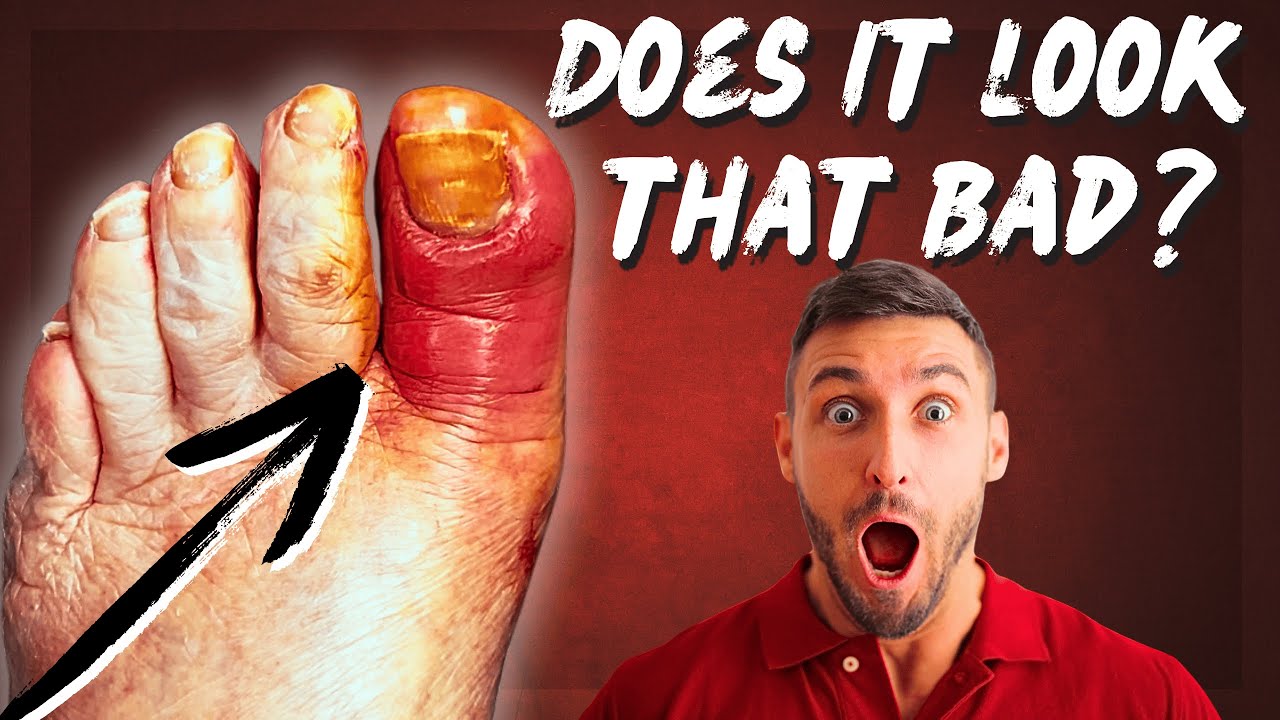 WHY IS YOUR TOE SO RED? SATISFYING ASMR OF INFECTED TOENAIL - YouTube