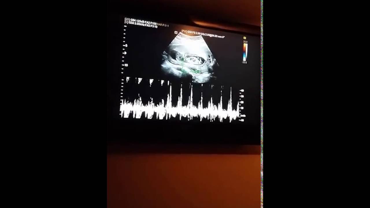 Ultrassom 12 semanas.translucência nucal. descobrindo sexo do bebe. Dr ...