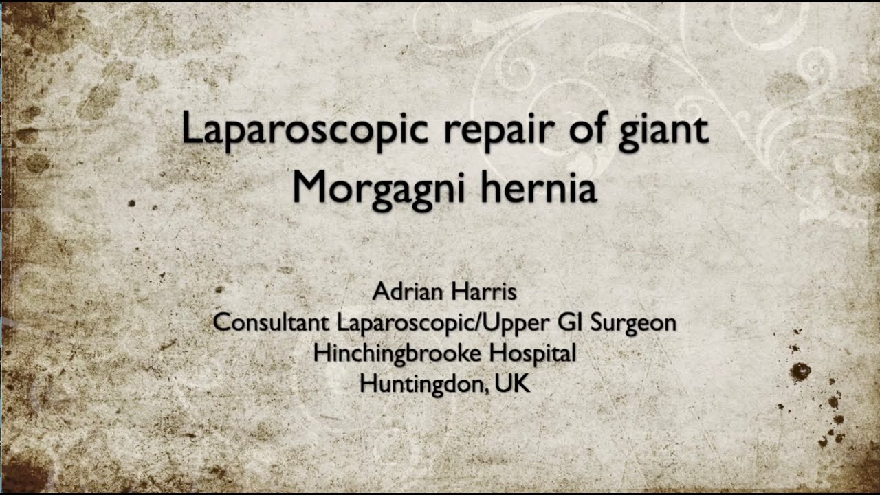 Laparoscopic repair of giant Morgagni hernia - YouTube