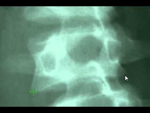 Measurement of axial vertebral rotation of lumbar spine. - YouTube