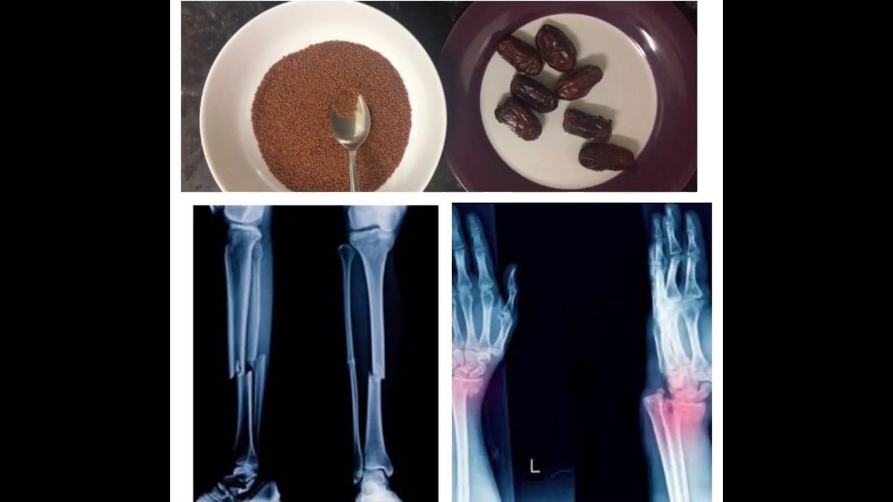 sida loo joojiyo lafa xanuunka | How to stop pain in bones - YouTube