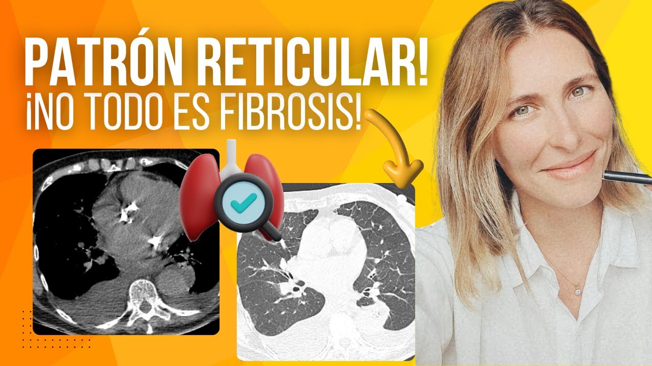 Aprende a Interpretar el Patrón Reticular en TC de Tórax en menos de 10 ...