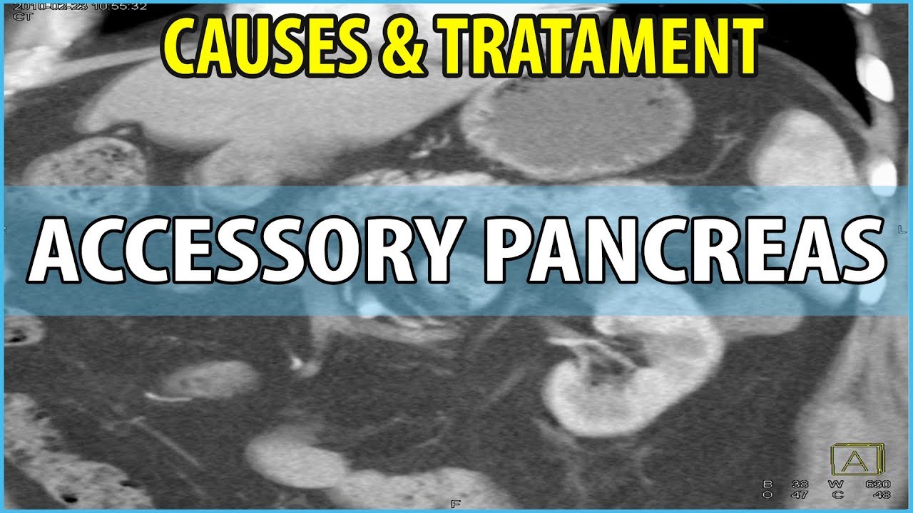 What is Accessory Pancreas, Causes, Symptoms and Treatments - YouTube
