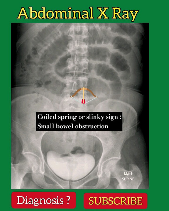 Coiled Spring Or Slinky Sign Small Bowel Obstruction Diagnosis
