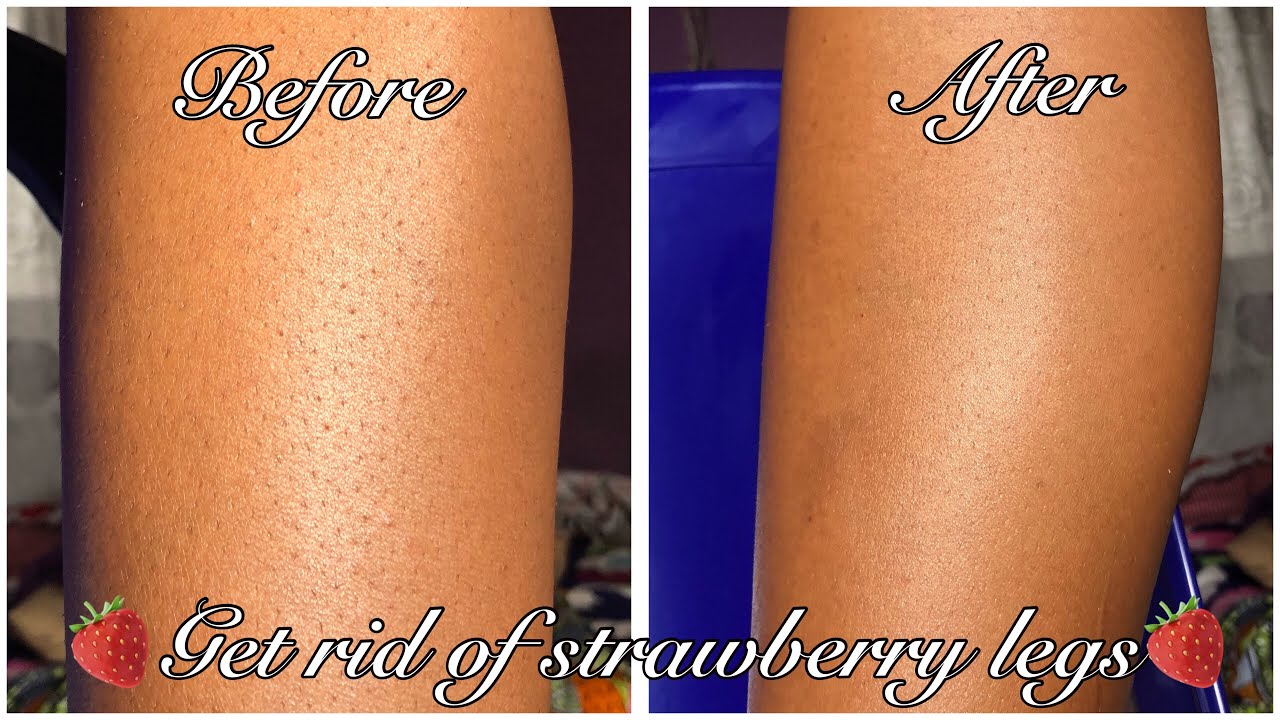 HOW TO GET RID OF STRAWBERRY LEGS: how to get rid of spots/bumps and ...