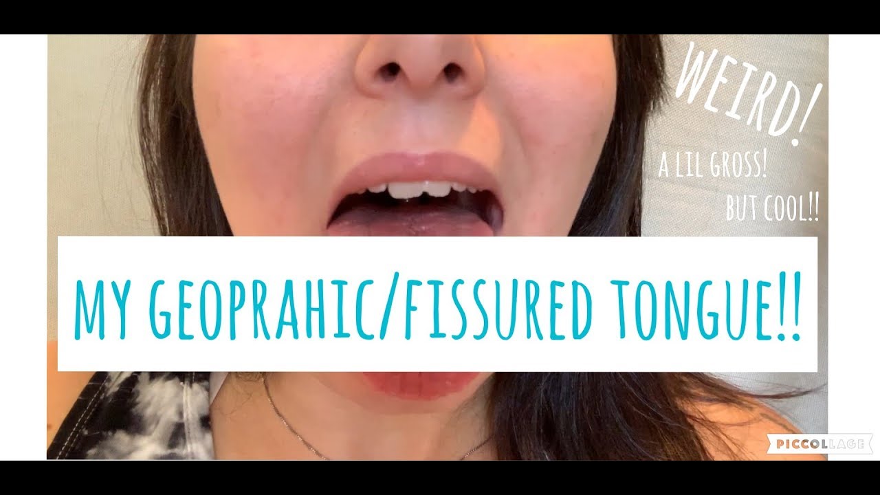 MY GEOGRAPHIC/FISSURED TONGUE! (cut up and scratched!!) - YouTube