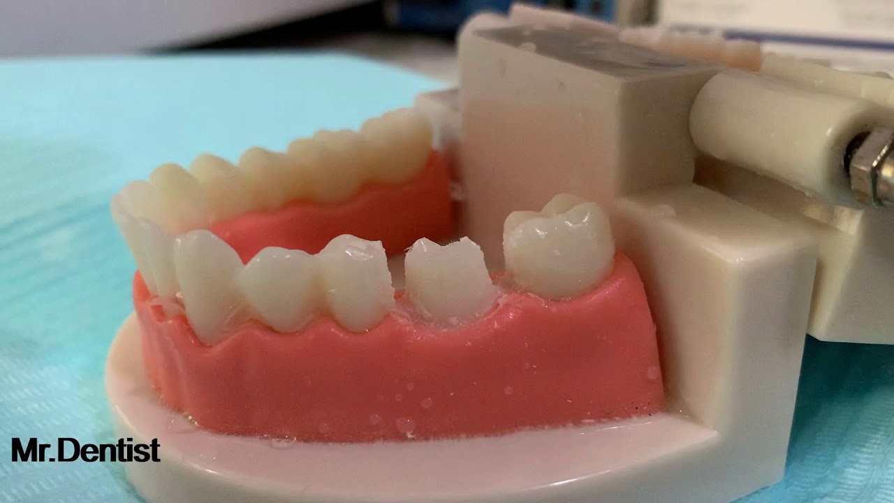 Crown Preparation Of A Molar !!!! - YouTube