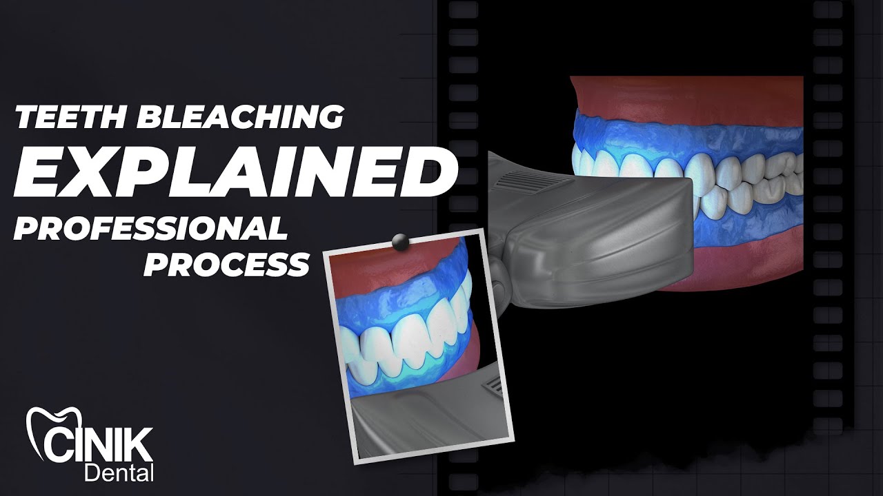 Teeth Bleaching Explained | Cinik Dental - YouTube