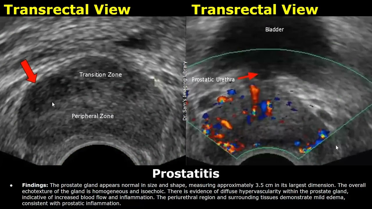 Prostate Ultrasound Reporting BPH Cancer Cyst Calcification Scan Prostate Ultrasound Reporting BPH Cancer Cyst Calcification Scan