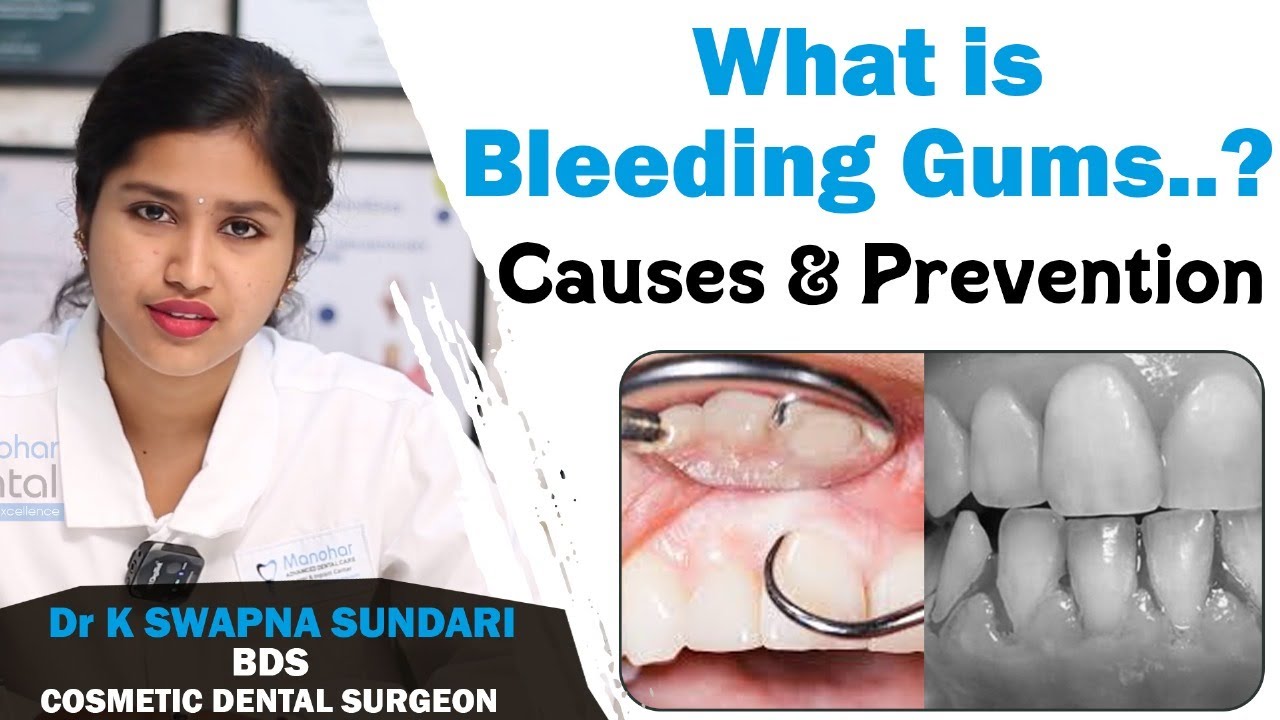 What is Bleeding Gums (Gingivitis) its Causes & Prevention || Manohar ...