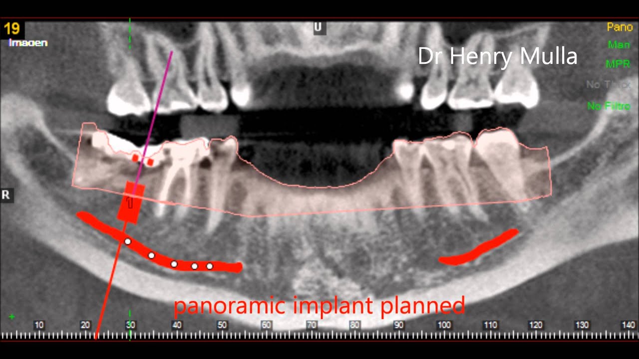 Ankylos Dental Implant placement using Crystal Guide - YouTube