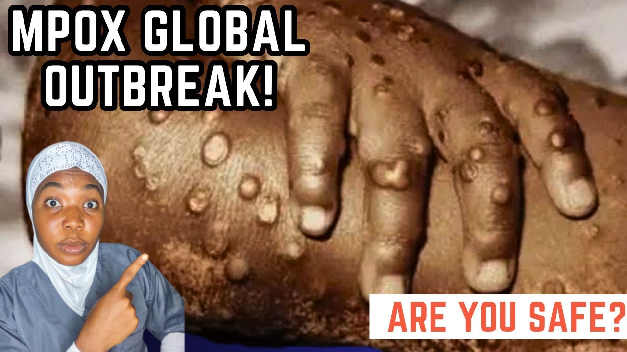 Monkeypox Outbreak 2024: Latest Updates, Symptoms, and How to Protect ...