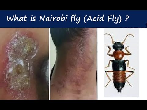 What is Nairobi fly (Acid Fly) ? All You Need To Know About Skin ...