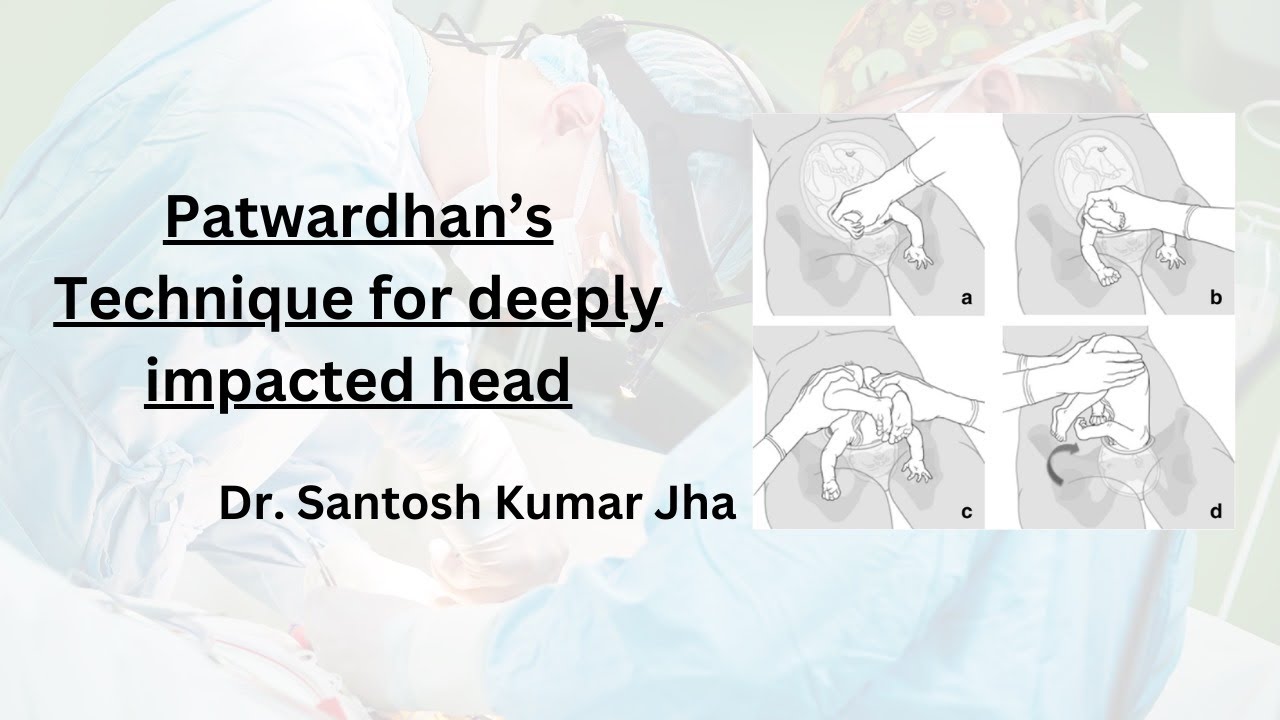 Patwardhan Manoeuvre - YouTube