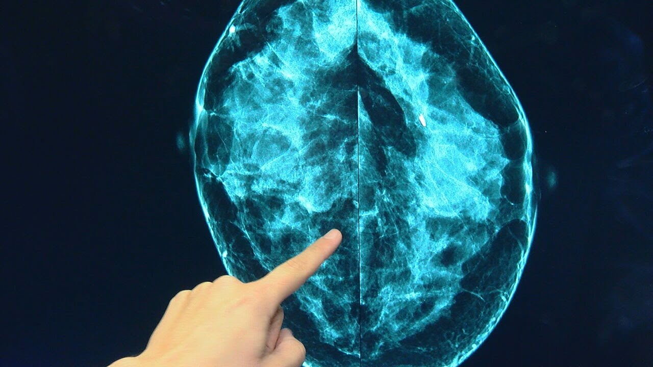 Kate's cancer diagnosis: Princess undergoing preventative chemo after ...