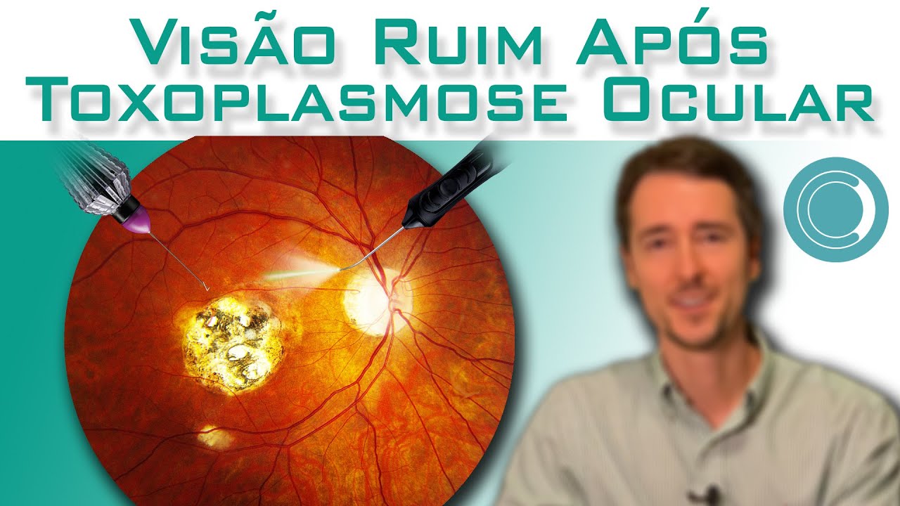 Toxoplasmose Nos Olhos Sintomas - NAZAEDU