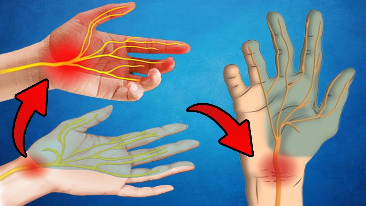 How to Fix Carpal Tunnel Without Surgery - YouTube