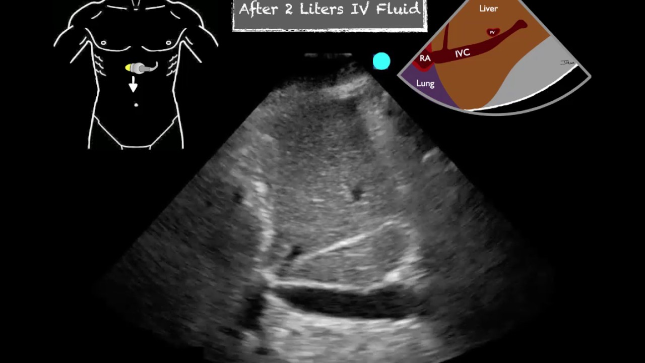 POCUS Cardiac IVC Change with fluids - YouTube