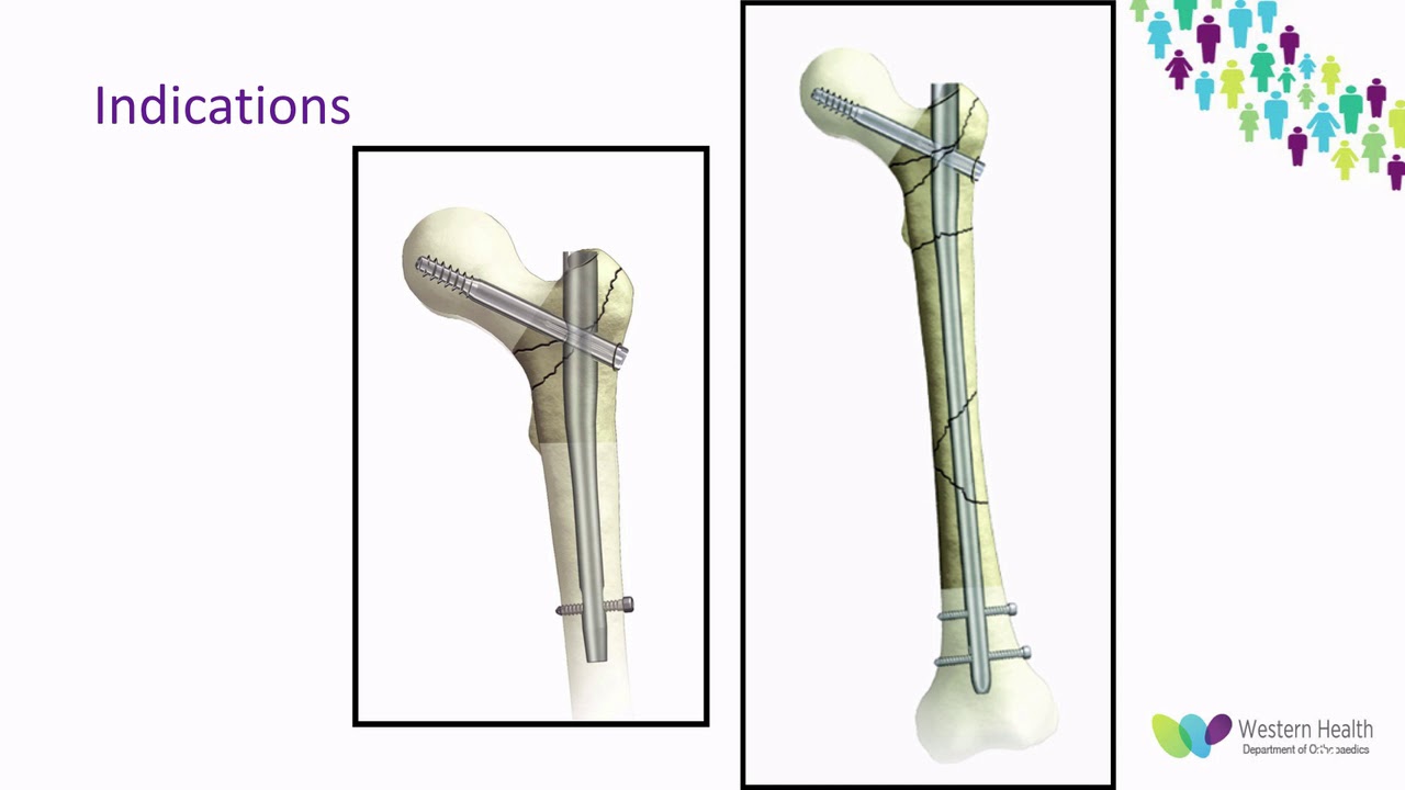 OrthoFracs Nail Length in Management of Intertrochanteric Femoral ...