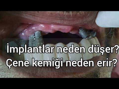 Diş implantları neden düşer? (Uzun dönem) İmplant etrafındaki kemik neden erir ?