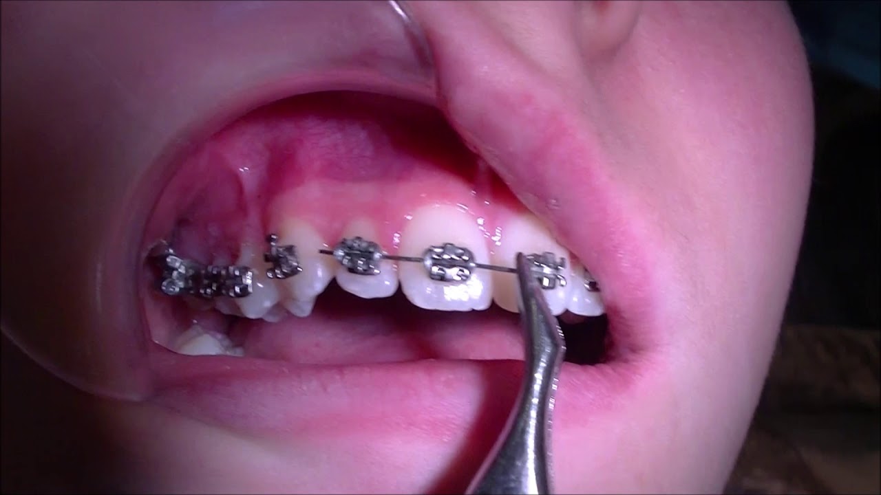 Bracket Synergy - YouTube