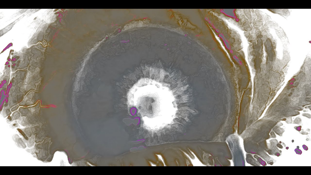Iris Bombata Cataract Surgery in hazy cornea and very deep and ...