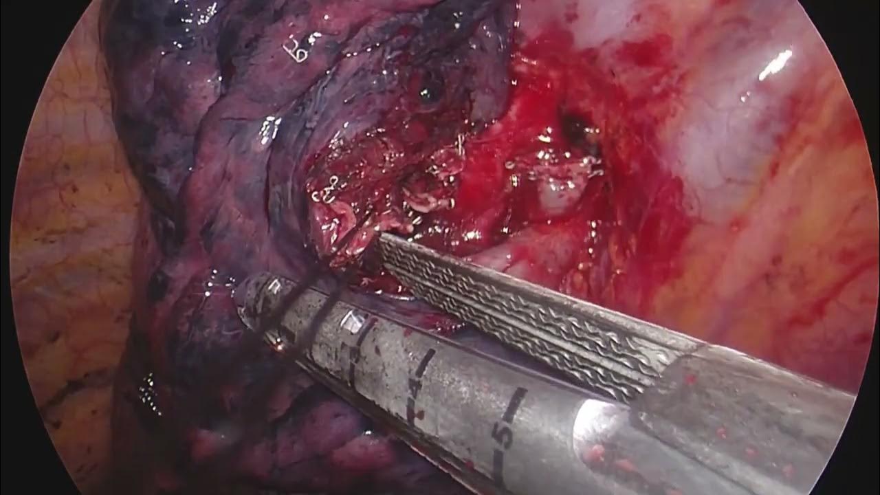 Uniportal VATS Right S1 (Apical segmentectomy) - YouTube