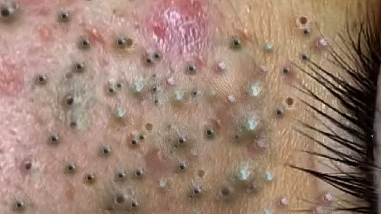 Big Cystic Acne Blackheads Extraction Blackheads & Milia, Whiteheads ...