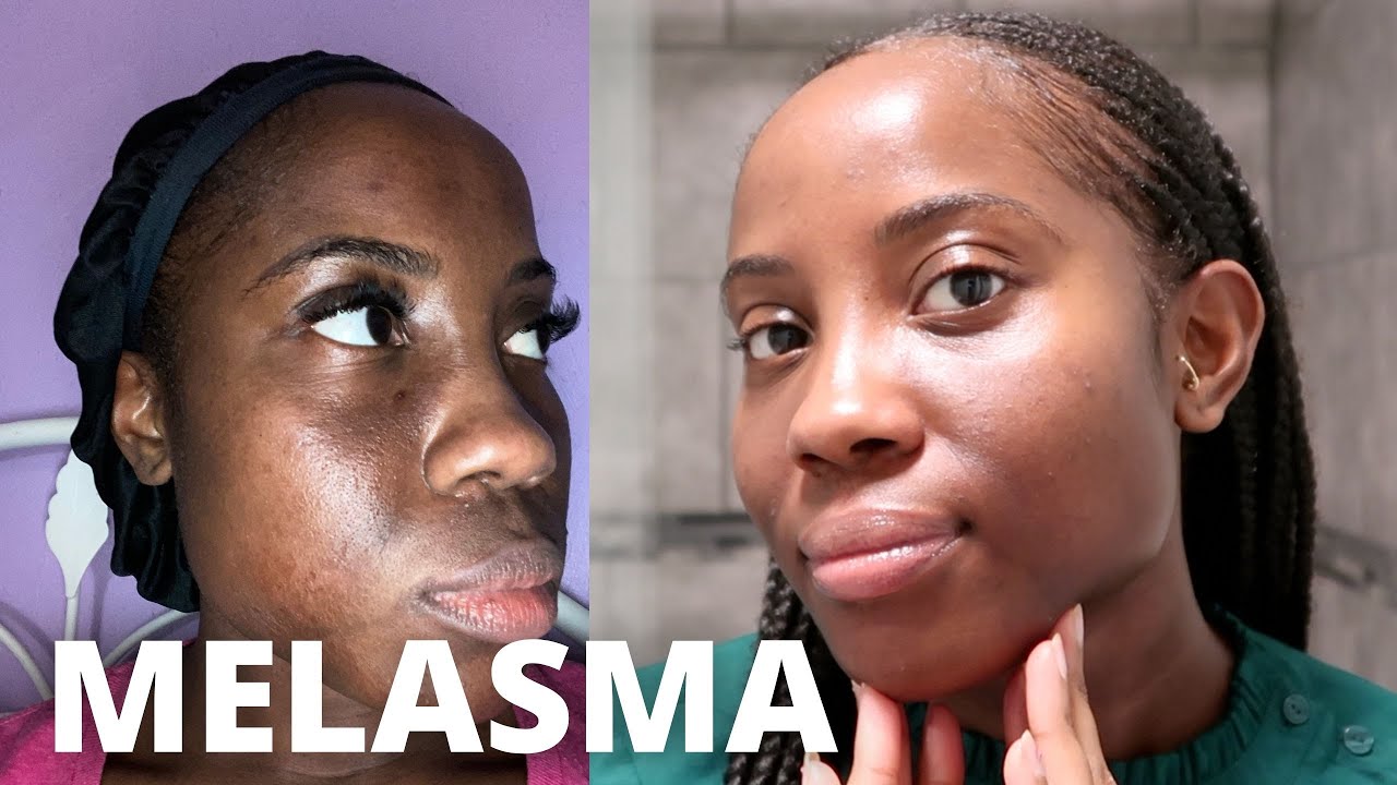 Melasma Skincare Routine using Musely - YouTube