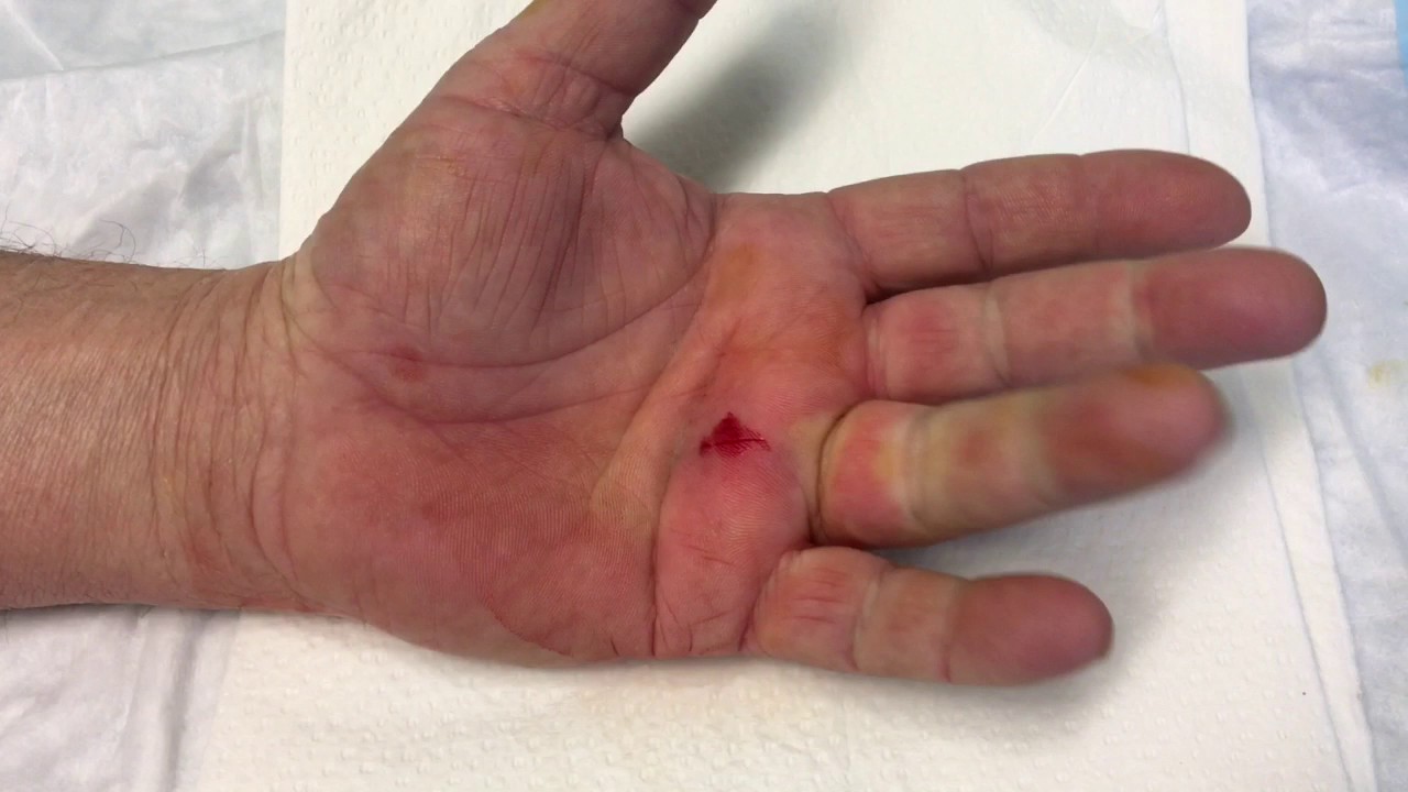 Dr Mora-Simple Trigger Digit Release - YouTube