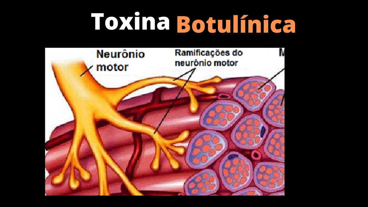 Toxina Botulínica; O conhecido botox - YouTube