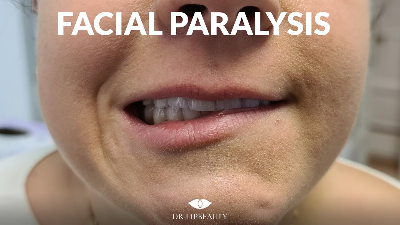 Botox facial paralysis DrLipbeauty - YouTube