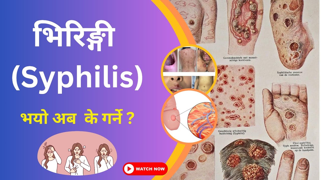 भिरिङ्गी Syphilis Bhiringi | Viringi lagnuko karan ? | Warning Signs ...