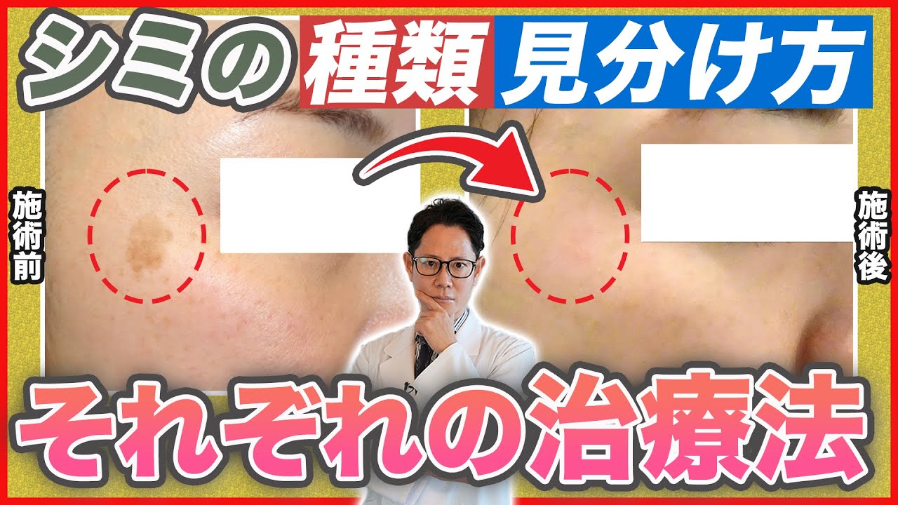 【シミ・肝斑治療】どう治す?しみの種類や見分け方と消す方法を解説 Youtube