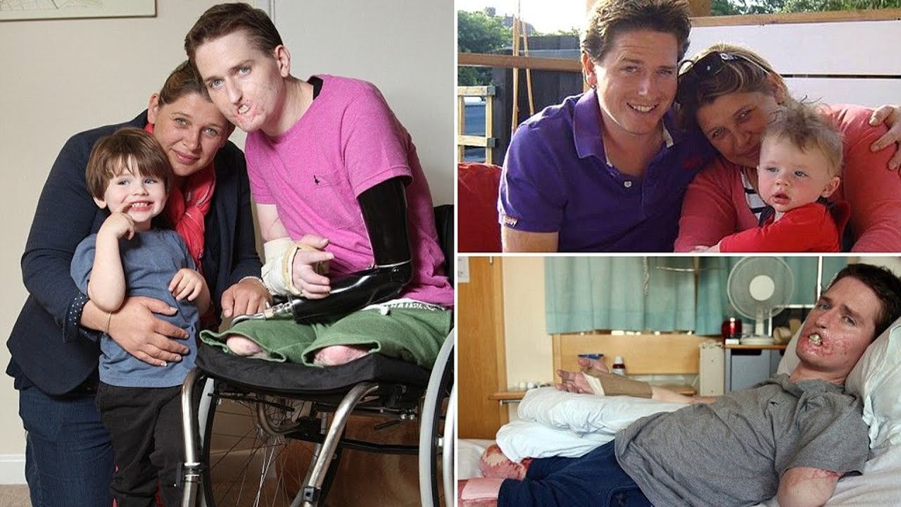 Alex Lewis😨 la HISTORIA su CASO, y la EXTRAÑA ENFERMEDAD que casi LO ...