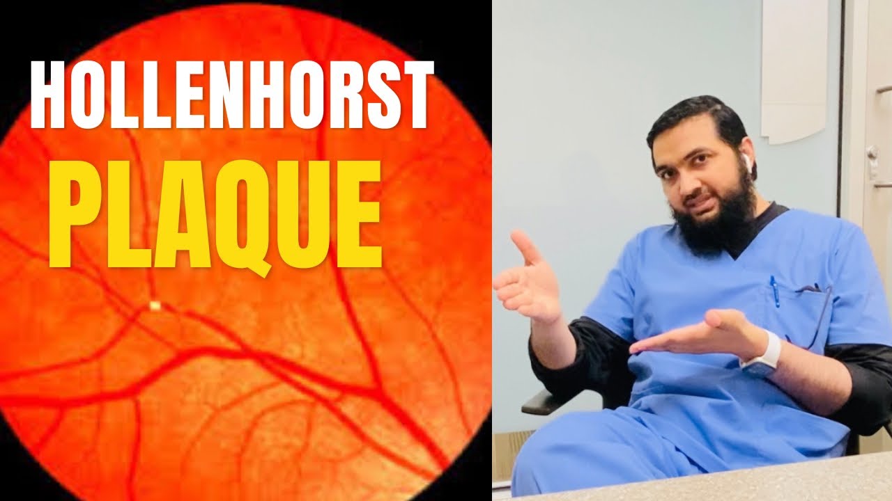 Hollenhorst Plaque:Closer Look with Dr.Usman Akbar- Expert Tips for ...