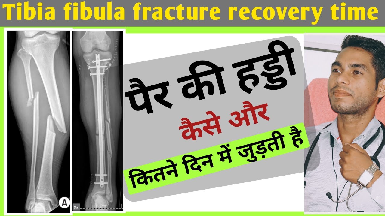 Tibia And Fibula Fracture Recovery Time