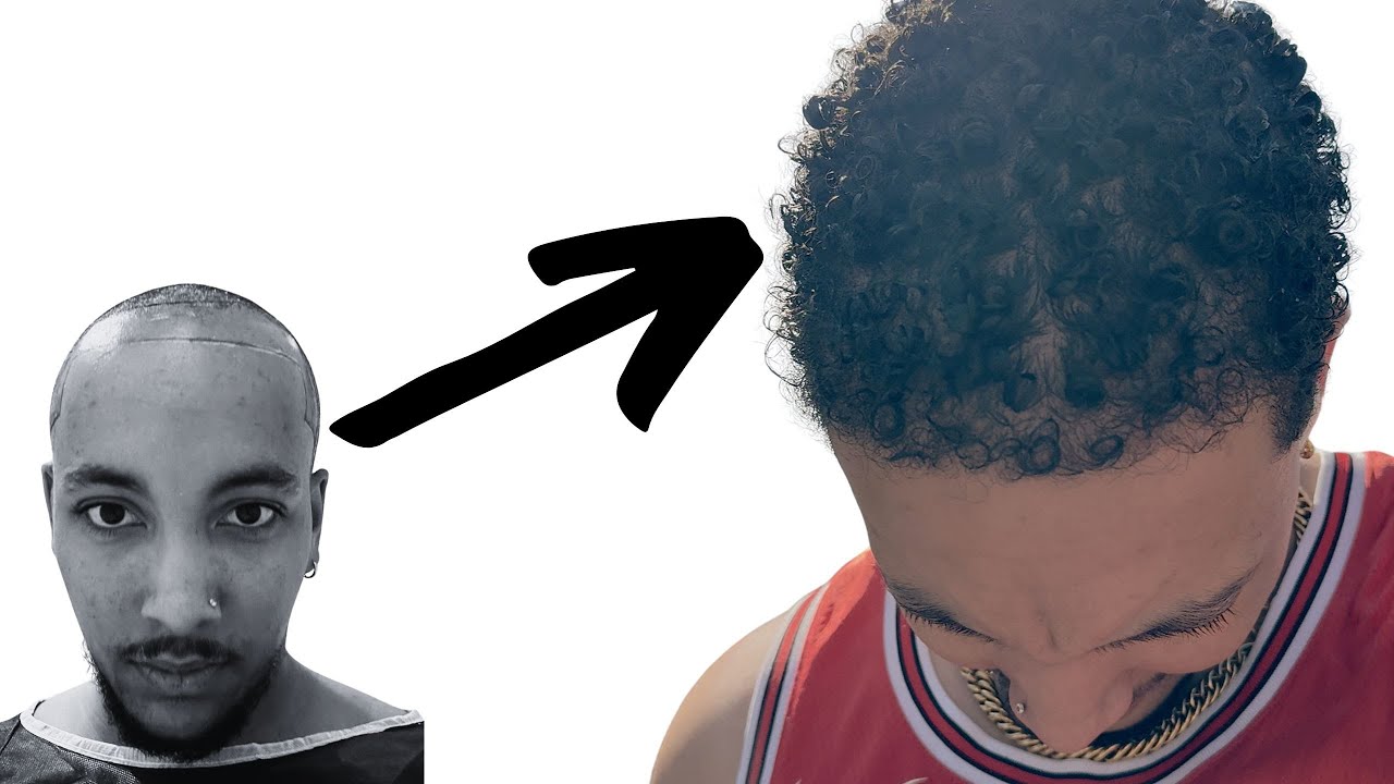 From Bald to CURL KING 👑 | How I Transformed My Hair Transplant into HD ...