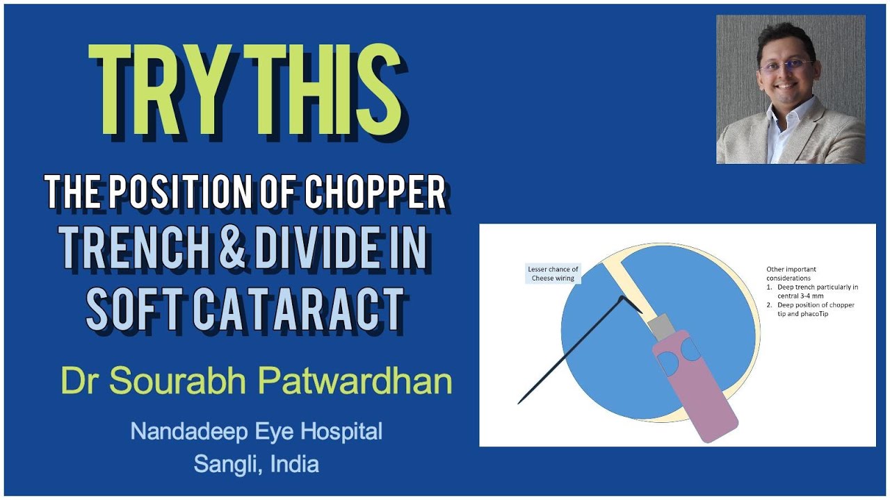 229 Position of tip of the chopper for trench & divide in Soft cataract ...