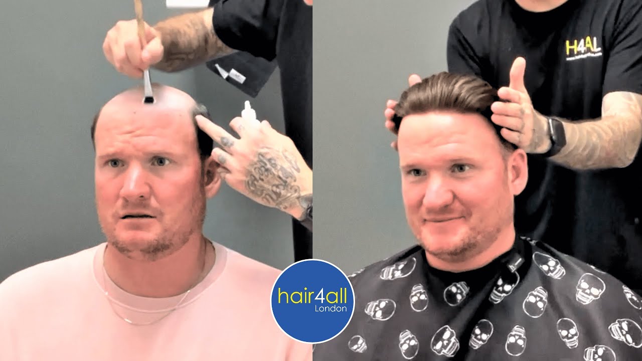Before & After | Hair System | Non-Surgical Hair Replacement System Men ...