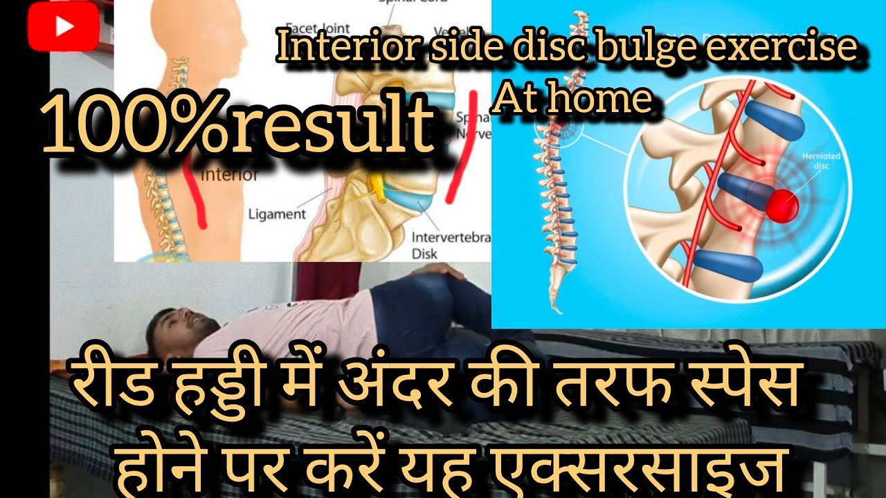 disc Bulge physiotherapy exercise at home. sciatica pain exercise - YouTube