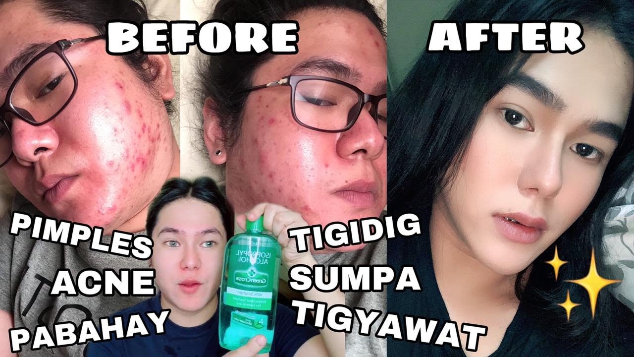 PANO NAWALA ANG AKING MGA TIGYAWAT/PIMPLES/ACNE? | Jordan Magno - YouTube