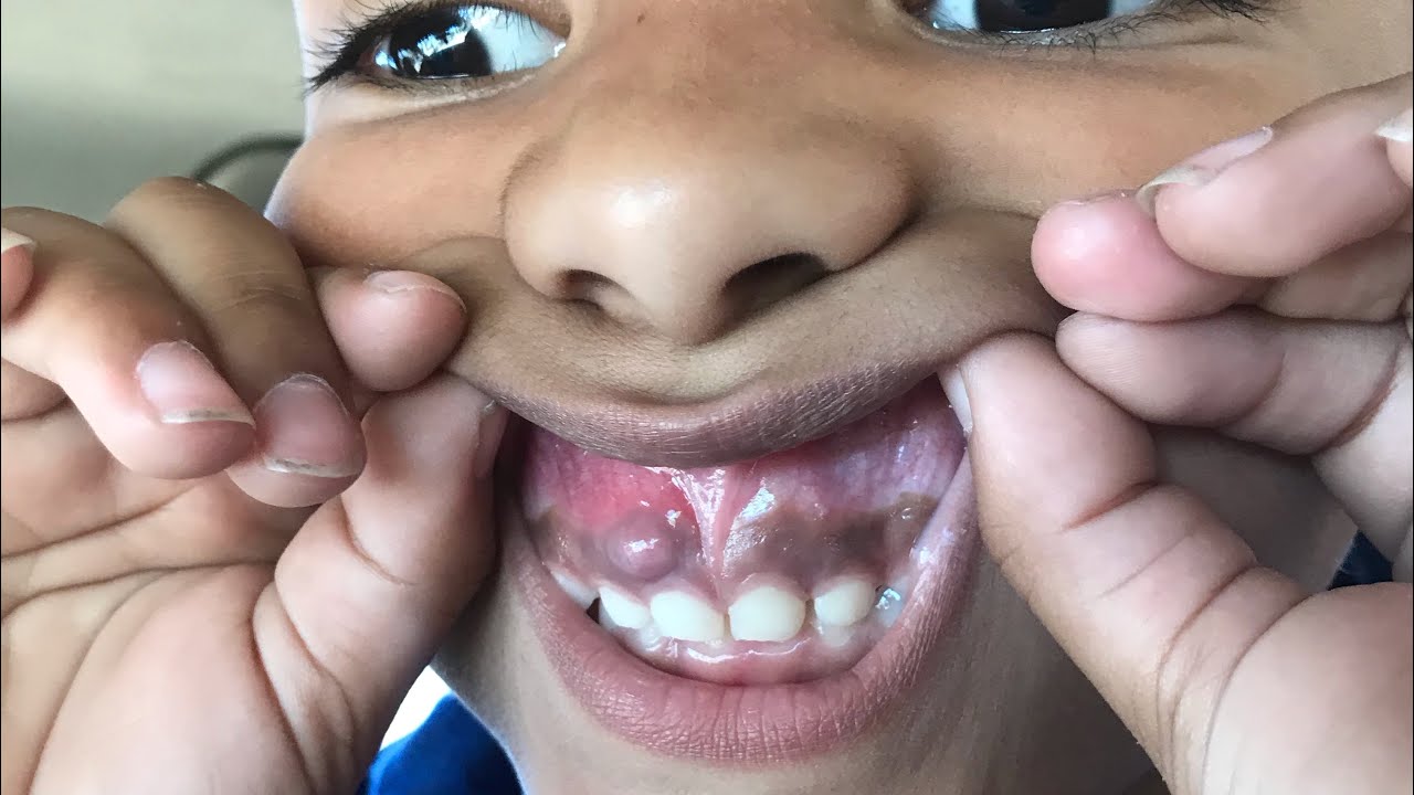 Extra Tooth Growing - YouTube