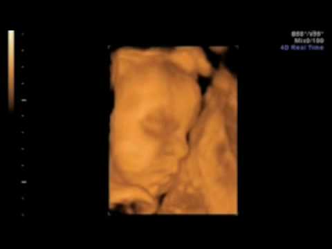 4D Ultrasound - Baby Dixon