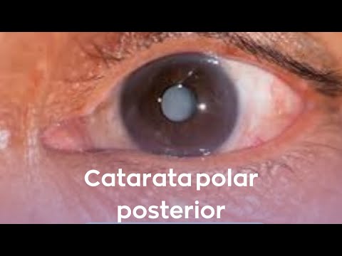 O que é catarata polar posterior? - YouTube