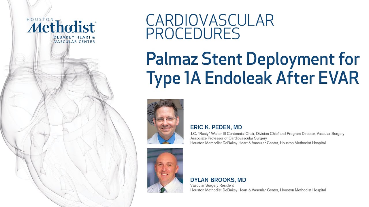 Palmaz Stent Deployment for Type 1A Endoleak After EVAR (Dylan Brooks ...