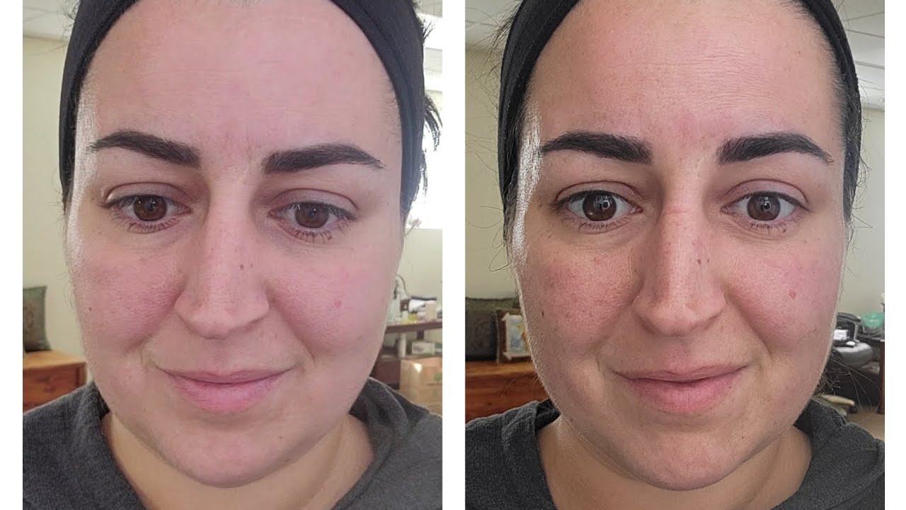 Cryo T-Shock self cryofacial treatment - YouTube