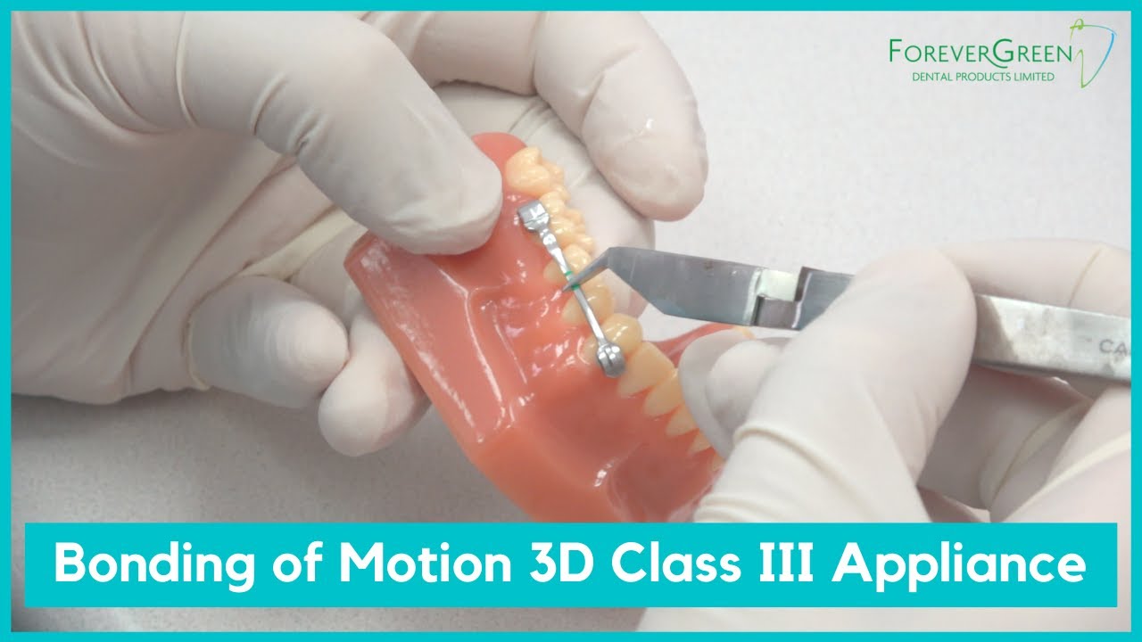Forever Green | Bonding of Carriere® Motion 3D™ Class III Appliance ...