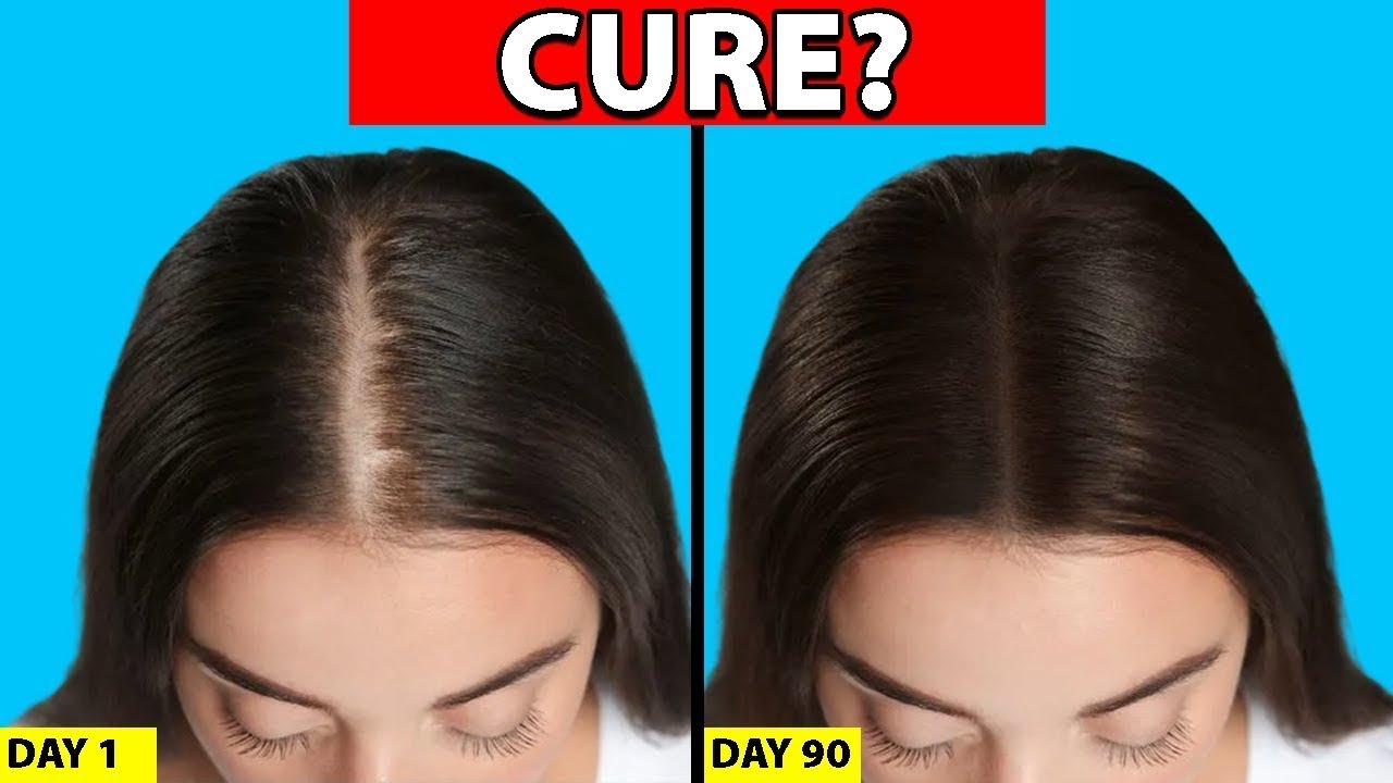 "NEW" Cure for Hair loss | FOLIX22 - YouTube